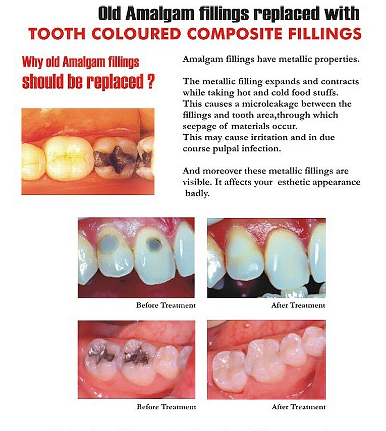 Amalgam Examples English at Mary Aplin blog
